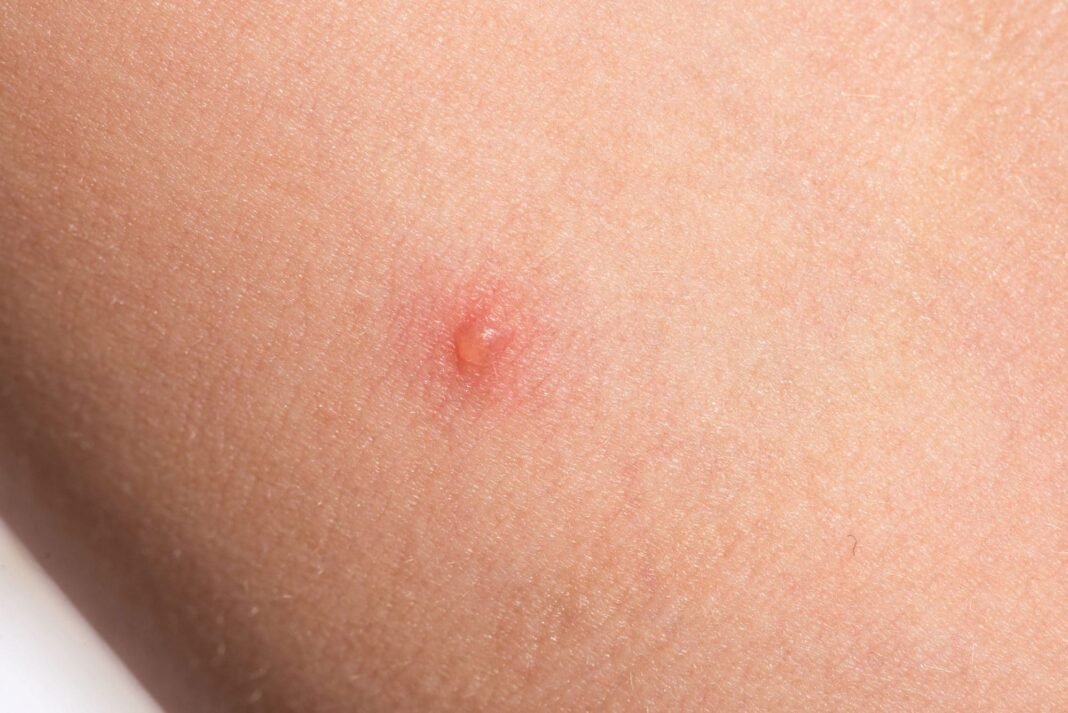 Noticing Itchy Red Bumps? Here’s What They Might Mean | Read My Story