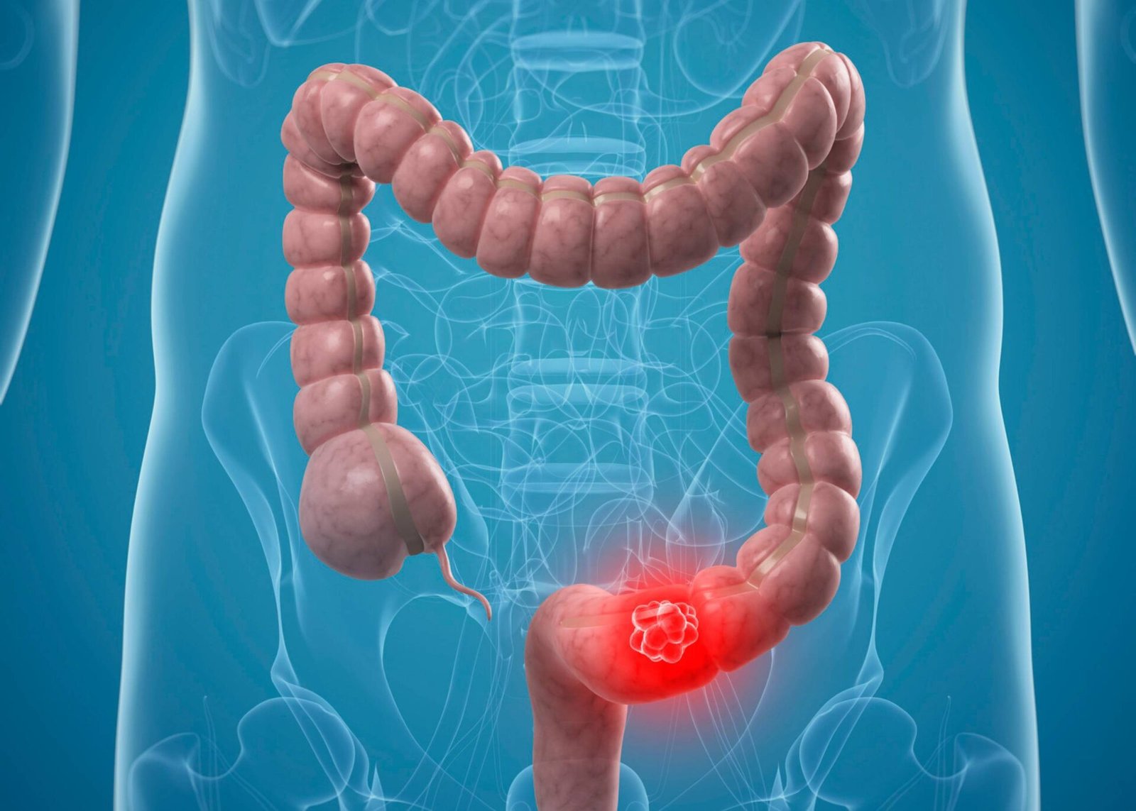 Woman reveals 5 colon cancer symptoms that shouldn’t be ignored | Read ...